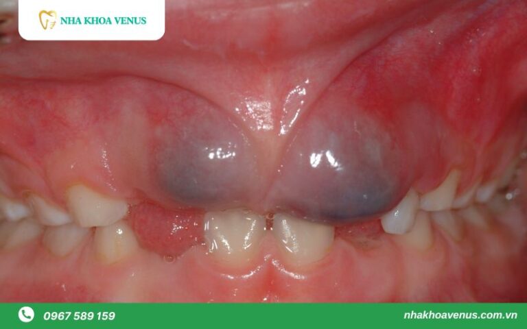 Phẫu Thuật Nang Răng Có Đau Không? Nha Sĩ Giải Đáp