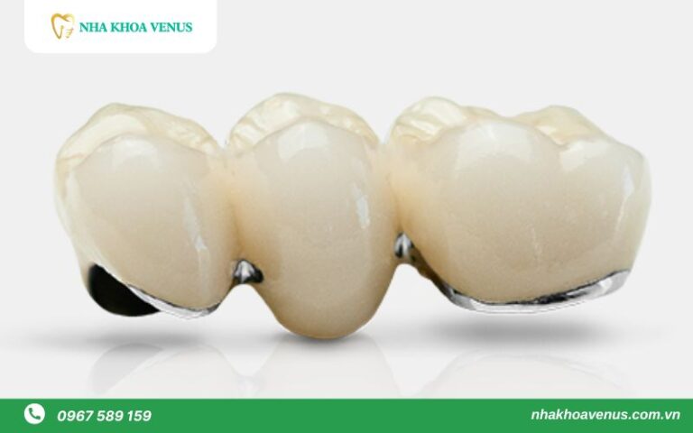 Răng Sứ Titan Tốt Không? Đặc Điểm Và Giá Của Răng Sứ Titan